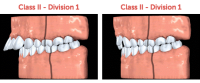 Classification Of Bites & How Orthodontics Can Help