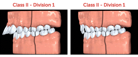 Classification Of Bites & How Orthodontics Can Help