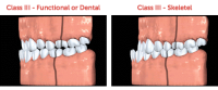 Classification Of Bites & How Orthodontics Can Help