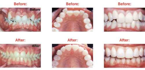 Orthodontics and Crowding & Spacing Of The Teeth